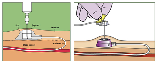 Chemo Port Needles – The Muslim Times